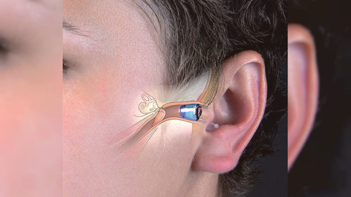 Hoppe Hörgeräte in Langenhagen: Unsere Im-Ohr-Hörsysteme: unauffällige ...